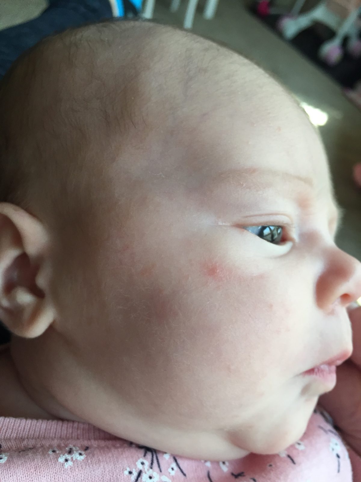 Newborn Skin Rash | What's that on your newborn's face?
