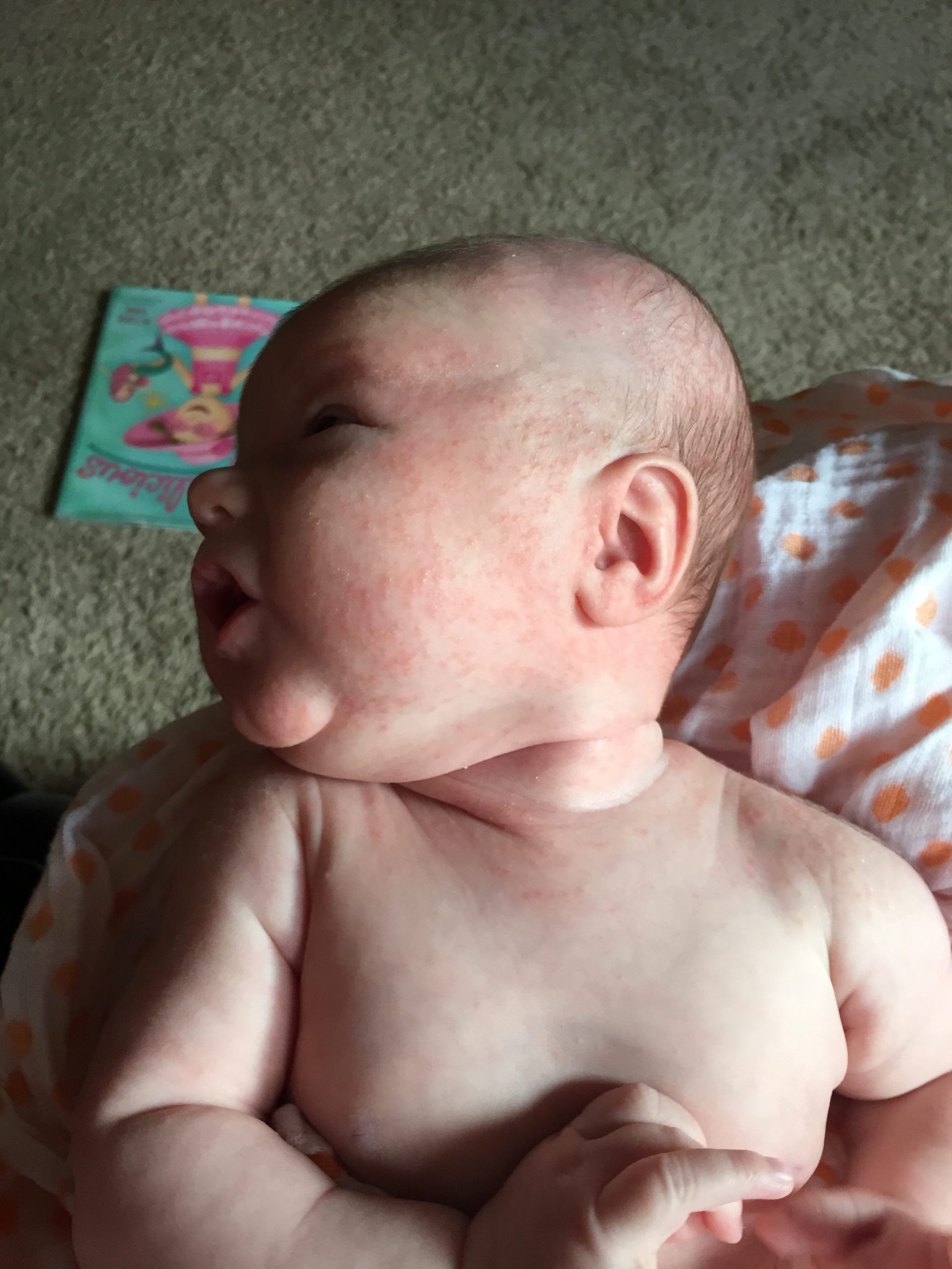 Newborn Skin Rash | What's that on your newborn's face?