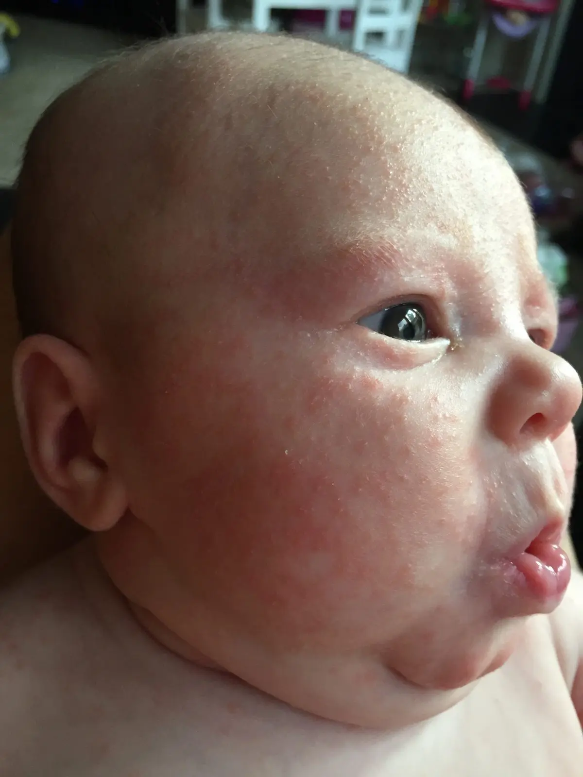 Newborn Skin Rash | What's that on your newborn's face?