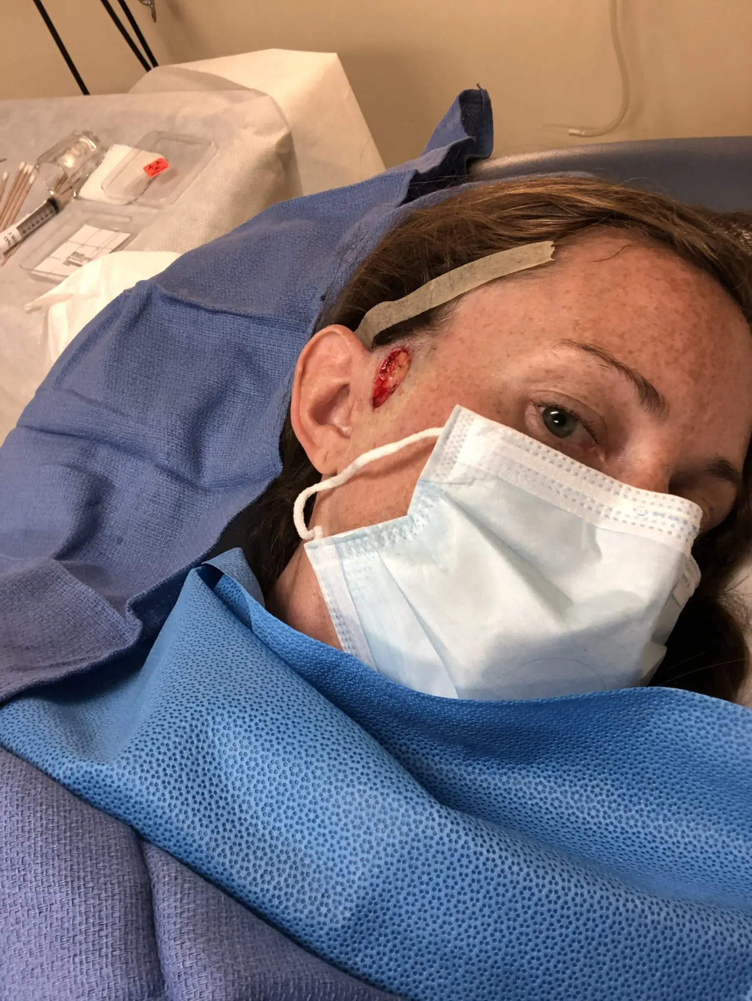 My Mohs Surgery Experience for Basal Cell Carcinoma - Caitlin Houston